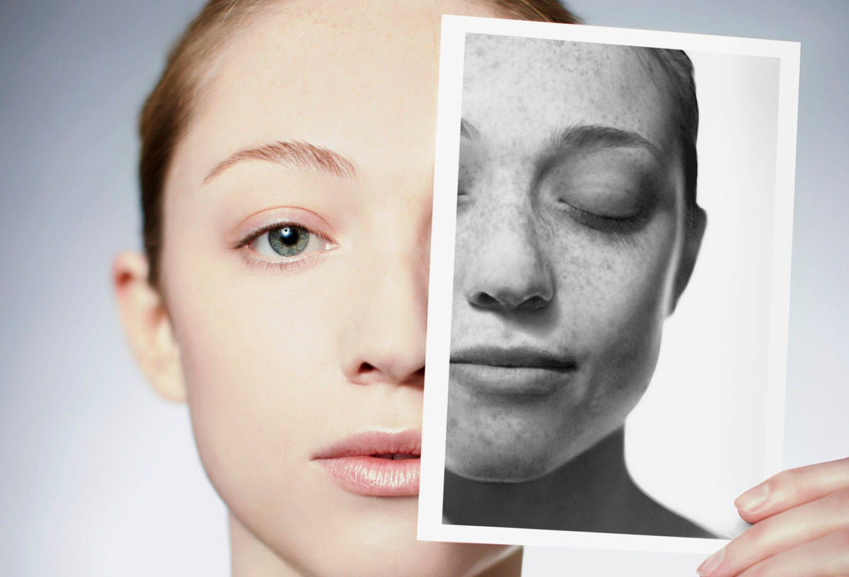 Sebaceous Filaments or Blackheads: How to Tell the Difference and Treat ...